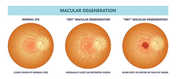 Macular Degeneration – City Optics